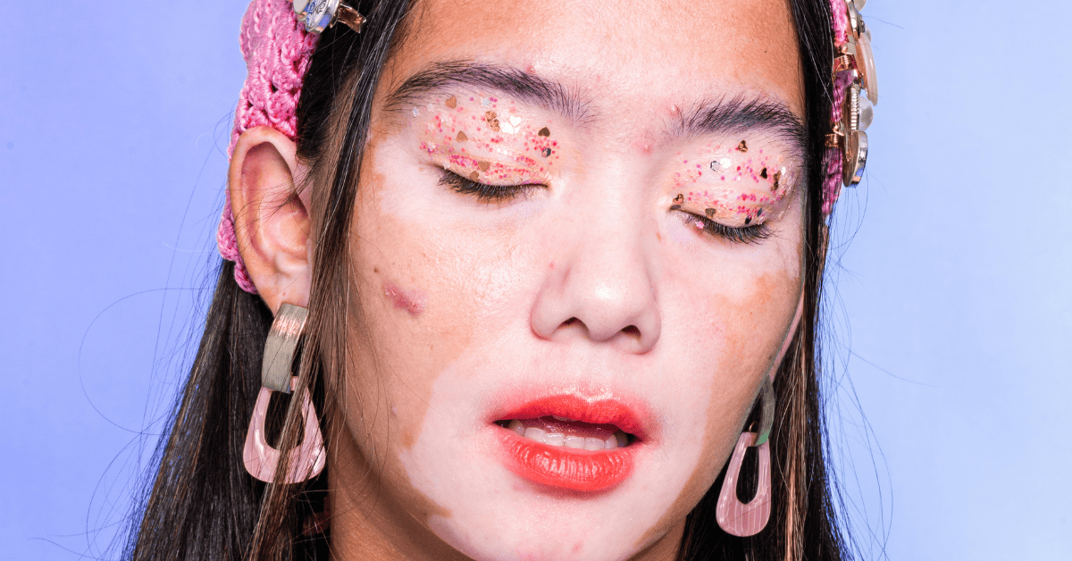 The Difference Between Rosacea And Hyperpigmentation - 2025 Complete ...