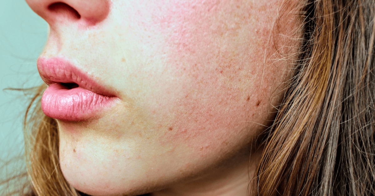 What's the Difference Between Eczema vs Rosacea - 2025 Comparison