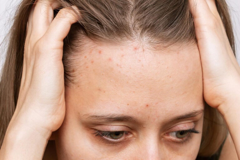 Helpful Ideas On How To Get Rid Of Bumps On Forehead - 2023