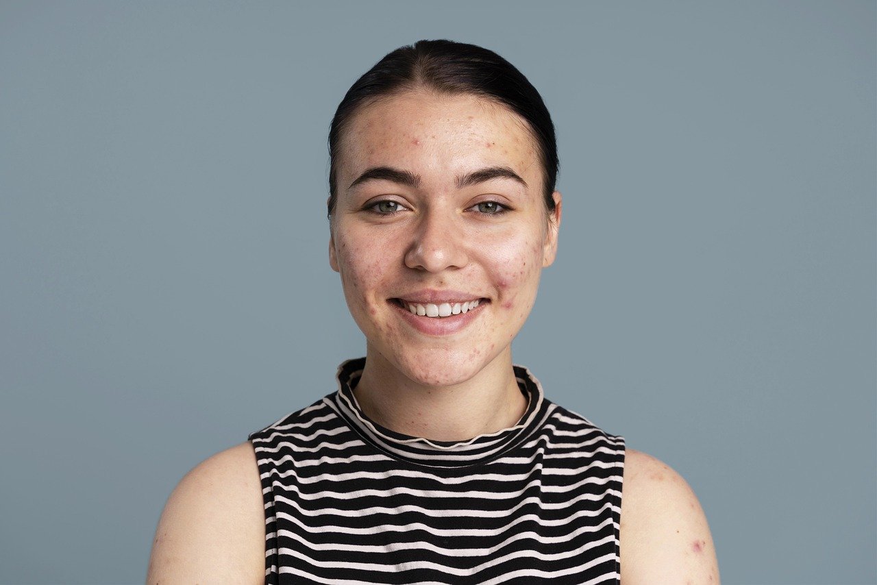 Common Signs How To Tell If Acne Is Hormonal Or Bacterial - 2024
