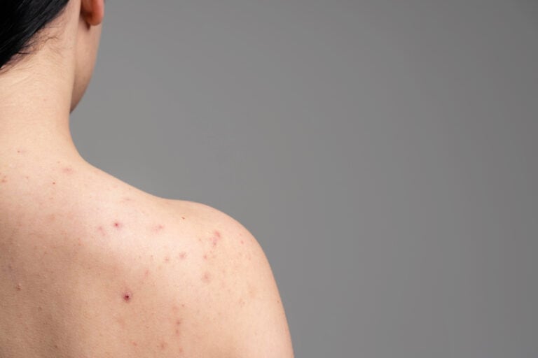 Helpful Ways On How To Get Rid Of Back Acne Scars - 2026